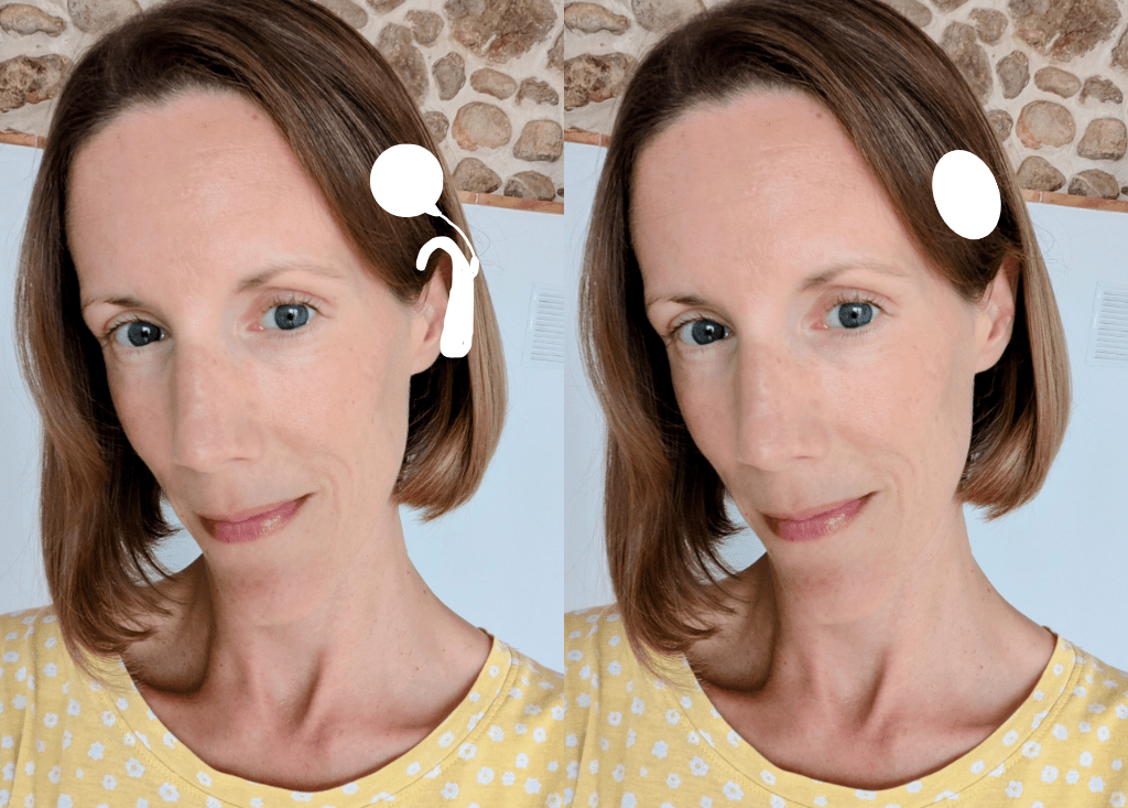 My Cochlear Implant Story: Part 8 – Choosing an Audio Processor – My ...